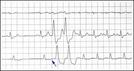 ECG 3.8