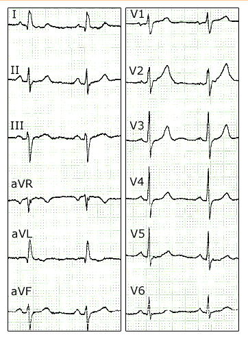 ECG 4.2